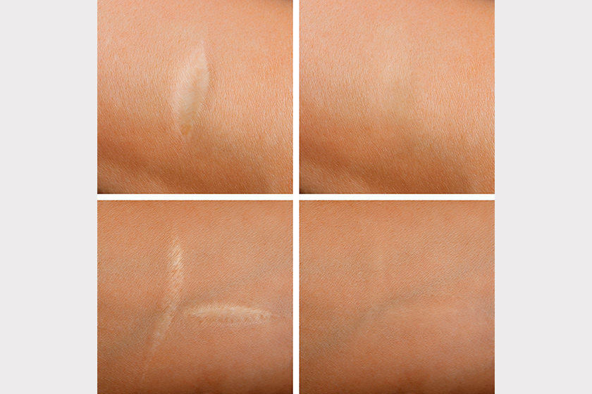 Cicatrizes: conheça seus tipos e os melhores tratamentos - Blog Supérbia