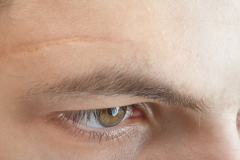 Saiba como funciona o método de compressão no tratamento de cicatrizes