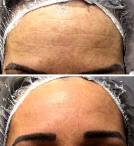 Como tirar rugas da testa? Confira 8 dicas - Blog Supérbia