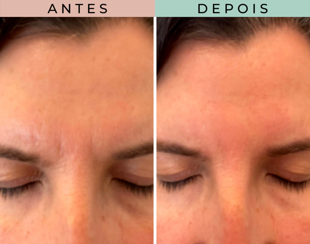 O que é a glabela? Conheça os tratamentos para essa região!