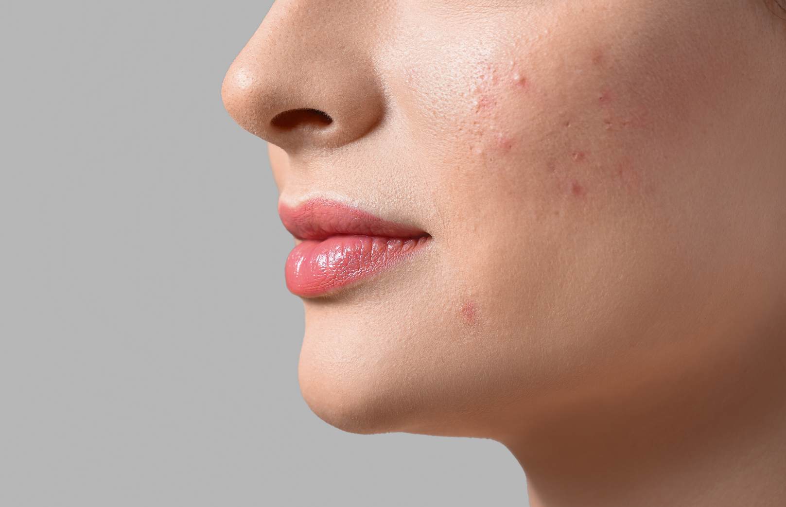 Dicas essenciais de cuidados para pele com acne - Blog Supérbia